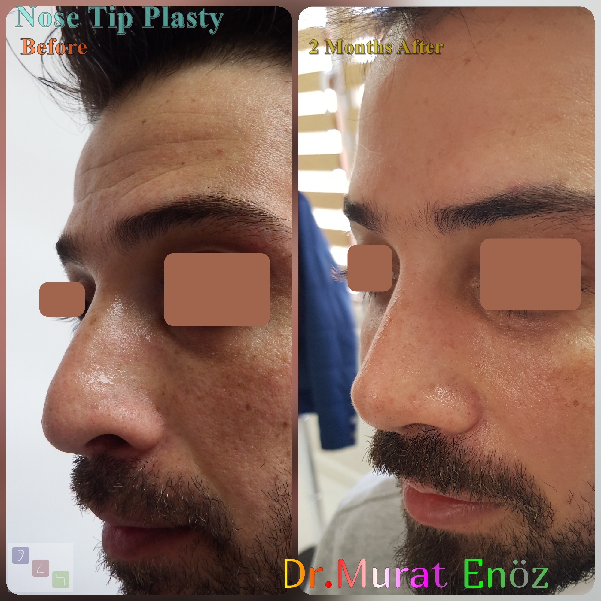 Tip Plasty Before And After
