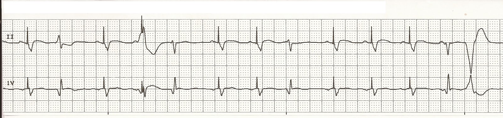 EKG Rhythm Strips 73