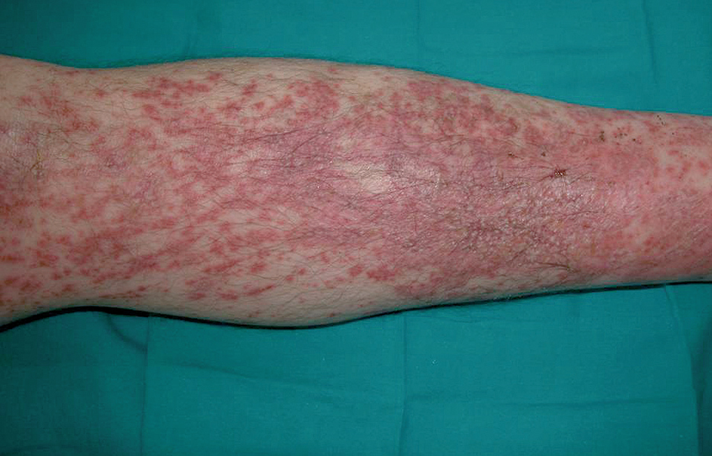 Control de Plagas en Sanidad Ambiental: Dermatitis de contacto por ...