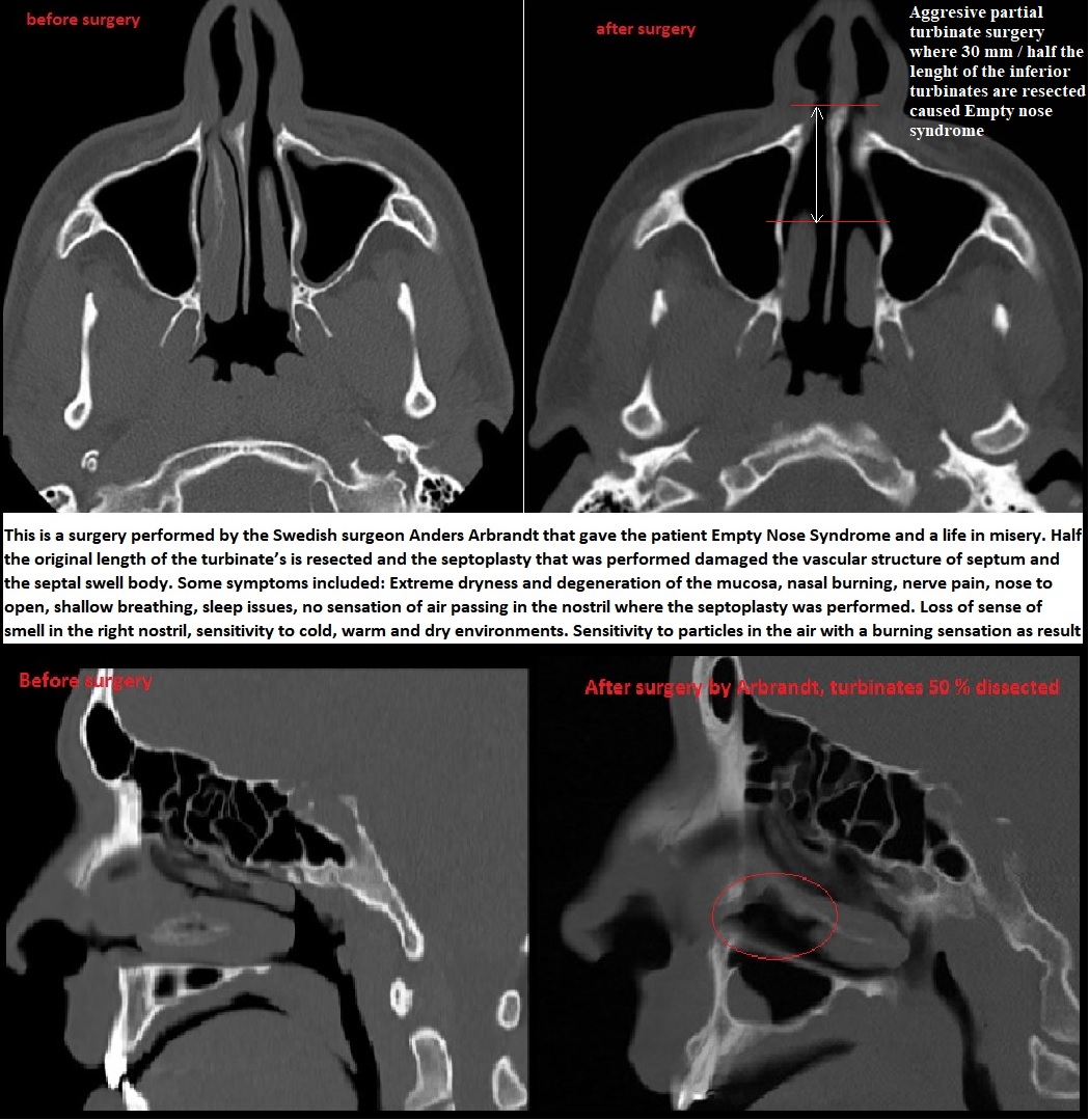 Visselblåsaren: Bränna näsmusslorna: Näsoperation - Komplikationer av ...