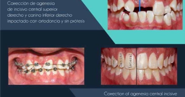 Odontopediatra Ortodoncista Dra. Ruth Nassi Rybak: CORRECCION DE ...