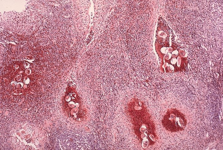 Infection Landscapes: Schistosomiasis