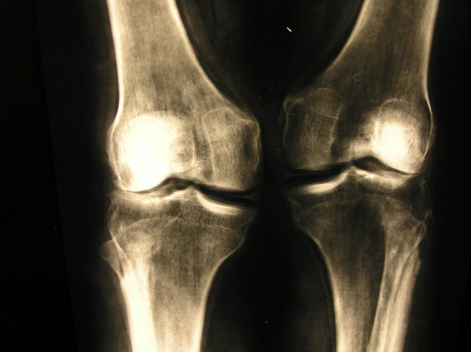 Rheumatologe: Chondrocalcinosis