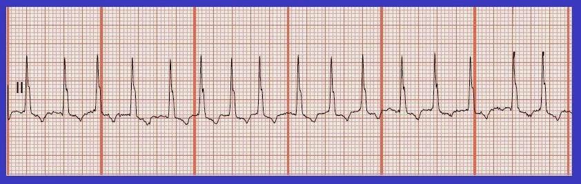 Practice Rhythm Strips 296