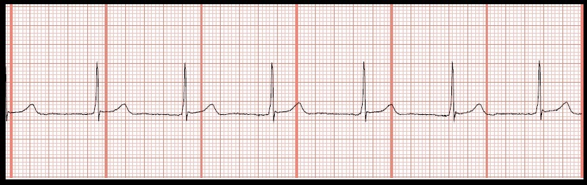 Practice EKG Rhythm Strips 146