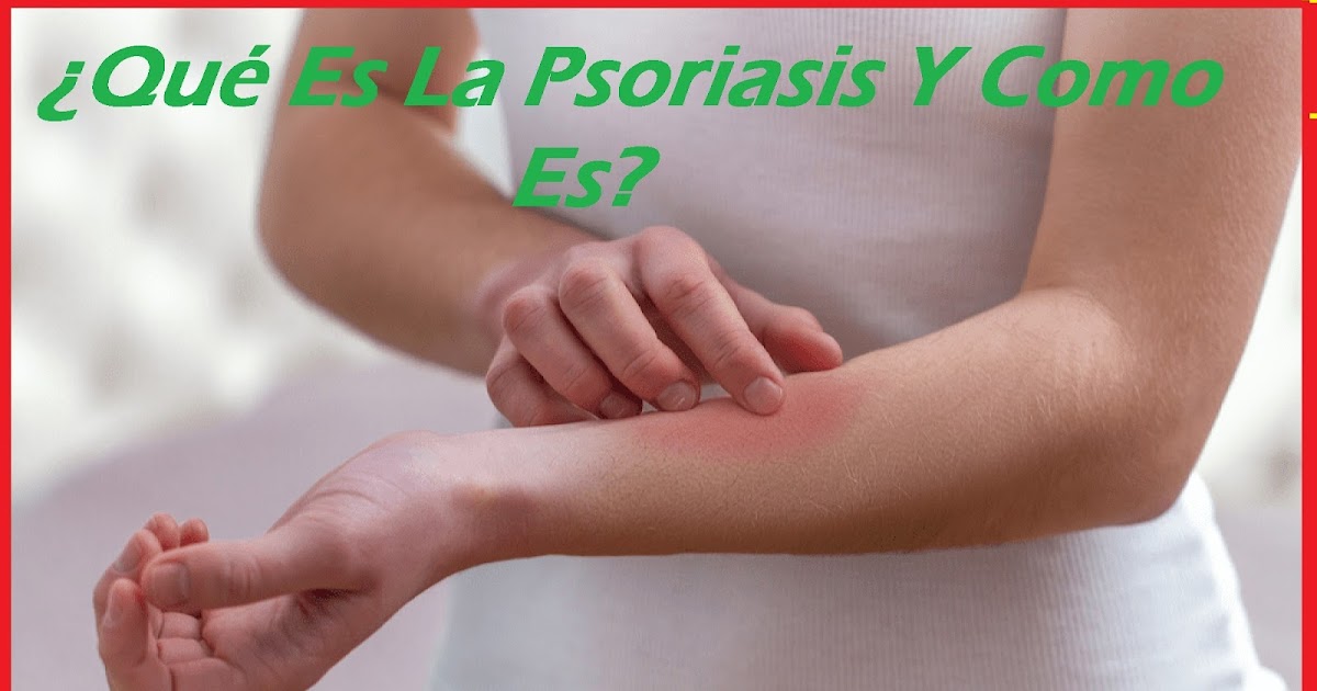 ¿Qué es la psoriasis y cómo se ve? ~ Psoriasis