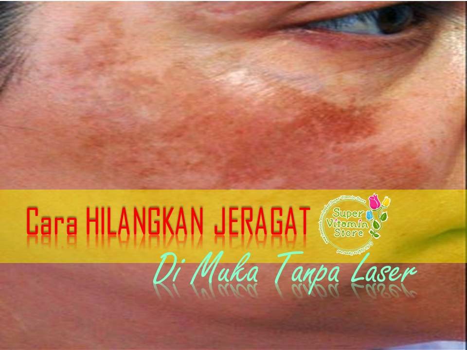 Cara Hilangkan Jeragat Di Muka Tanpa Laser - Story of Health & Beauty