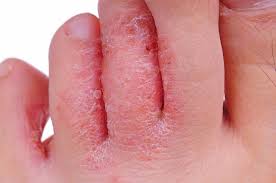 Smelly Feet? Find out Solutions and Prevention for Athletes Foot!