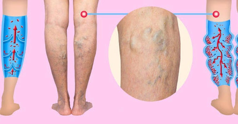 🤒 Causas de las Varices: 🦵 Qué son las varices