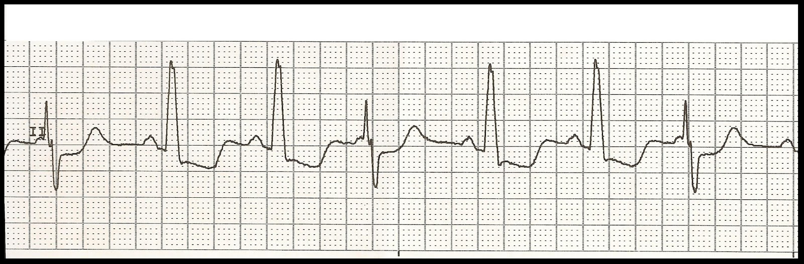 ECG Rhythm Strip Quiz 95 Ventricular ectopy