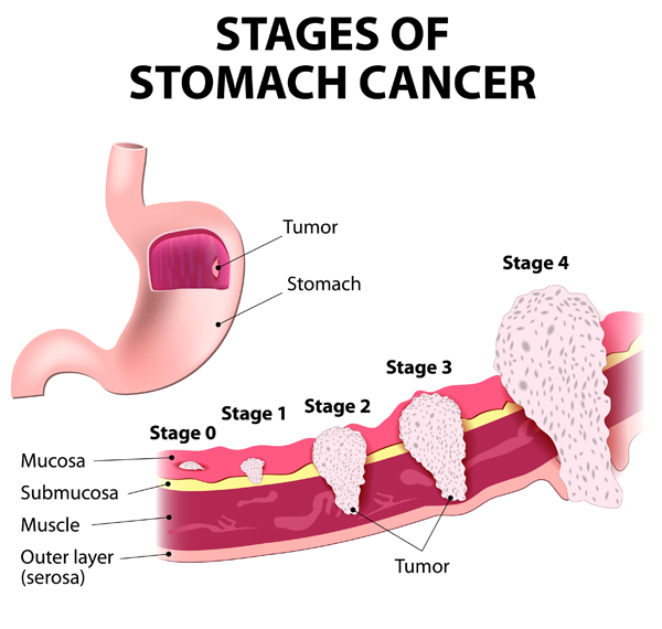 Stomach Cancer Symptoms And Risk Factors stomach-cancer-symptoms-and-risk-factors