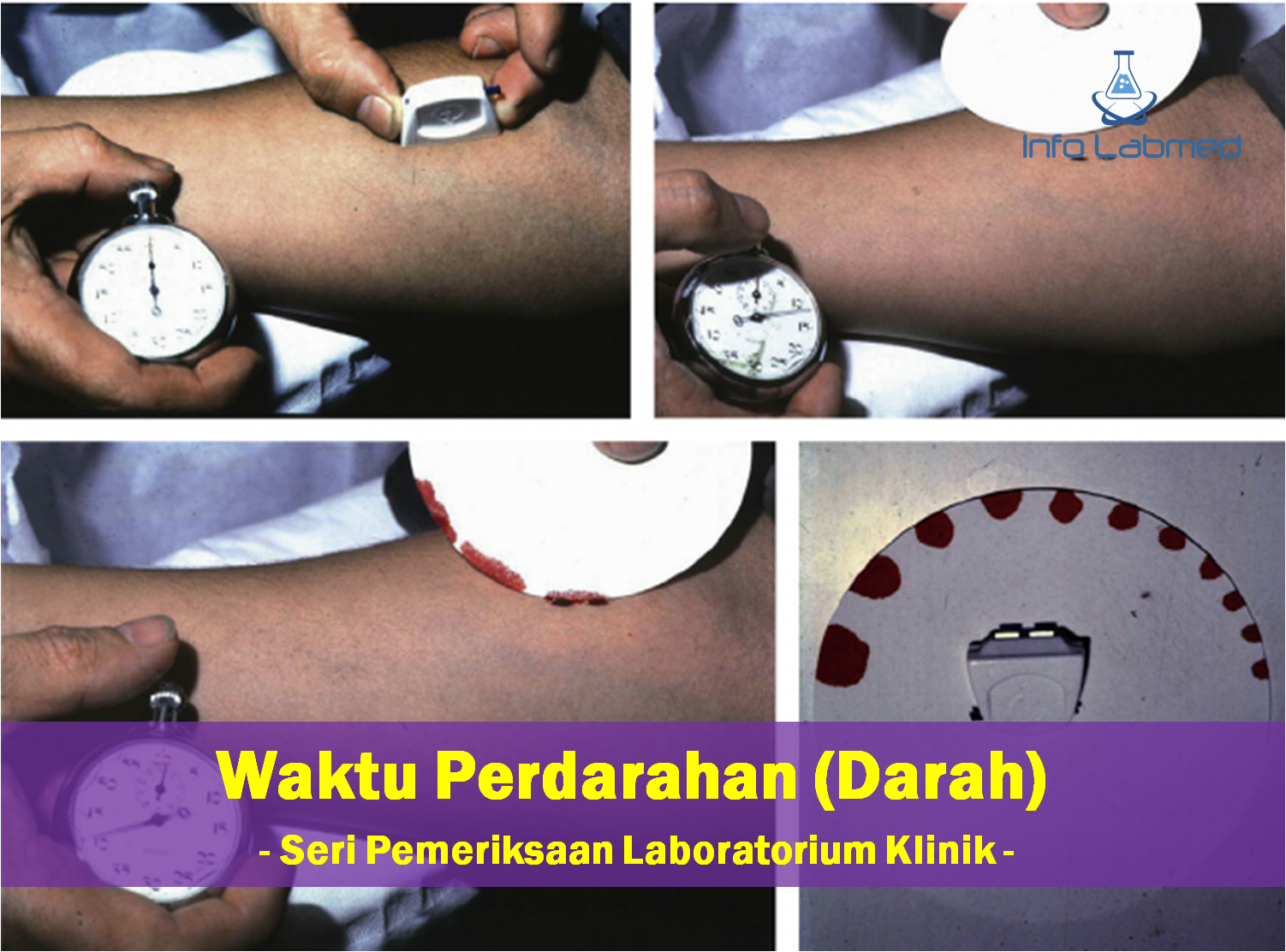 Waktu Perdarahan (Darah) - Seri Pemeriksaan Laboratorium Medika