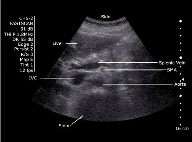 Adult Emergency Medicine: Abdominal Aorta Ultrasound
