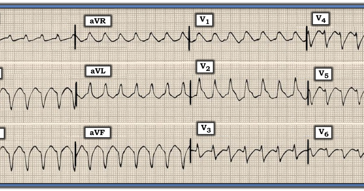 ECG Interpretation: ECG Blog #196: VT vs Aberrant? Adenosine?