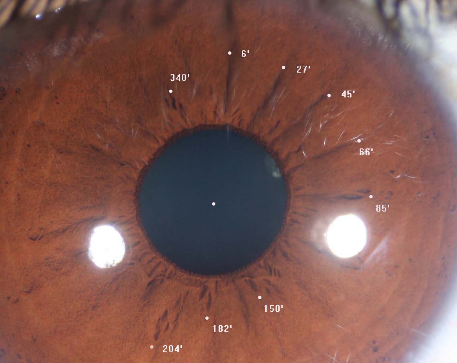 Modern & Multidimensional Iridology: Closed Lacunae, Restricted ...