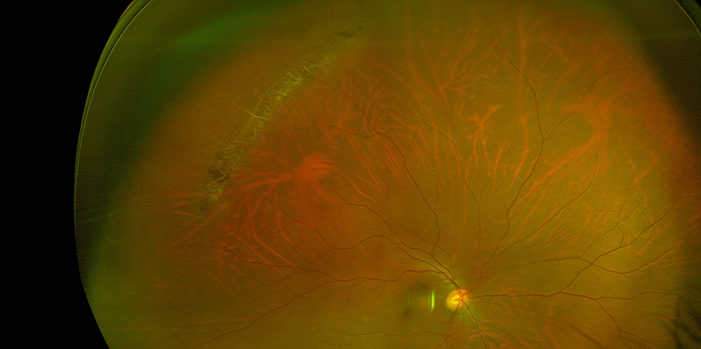 Sonoran Desert Eye Center: LATTICE DEGENERATION