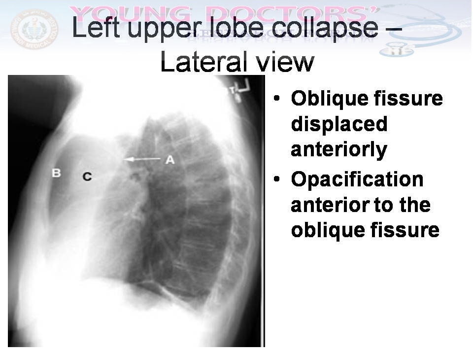Quick Diagnosis Of The Chest X-Rays (CXR) ~ YOUNG DOCTORS' RESEARCH FORUM