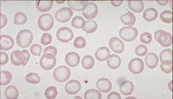 HEMATOLOGIA: ANEMIA MICROCITICA HIPOCROMICA