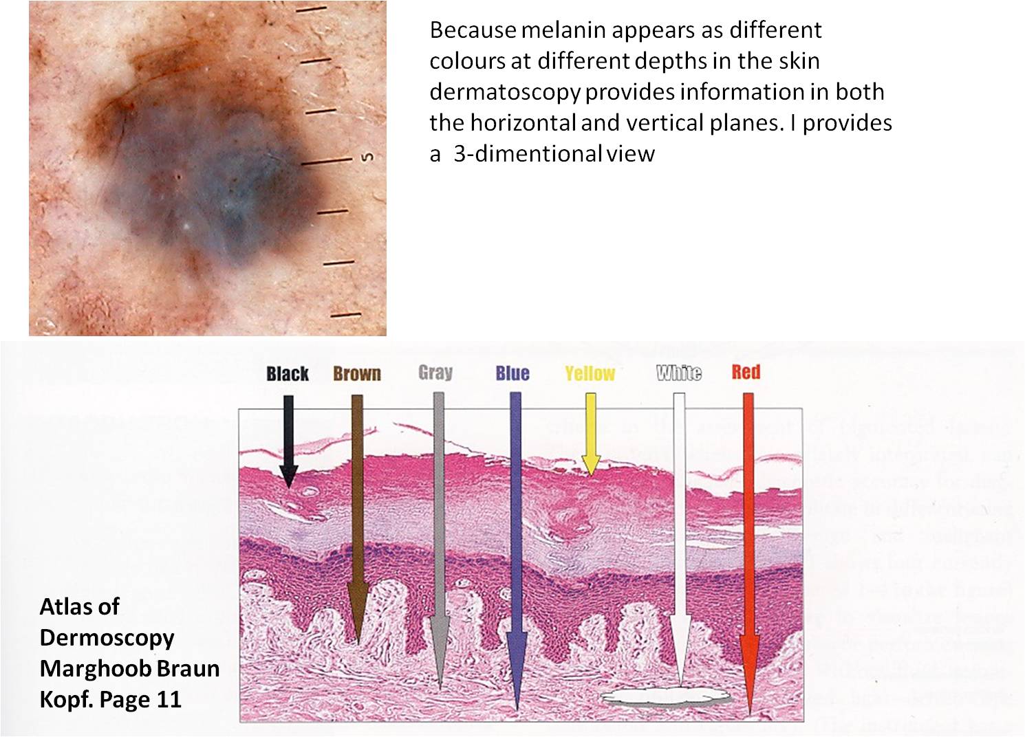 Introduction to Dermatoscopy
