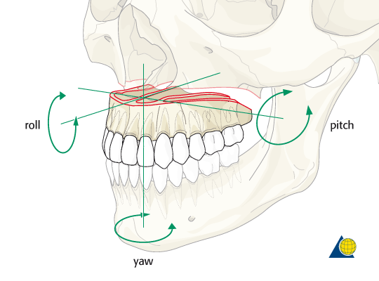 Anterior maxillary distraction osteogenesis
