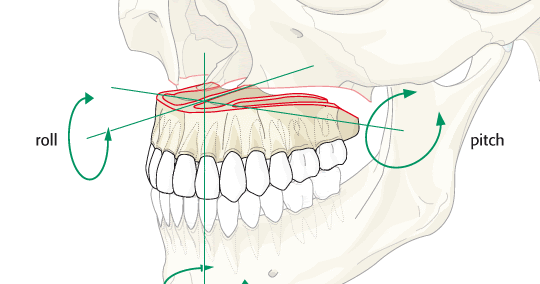 Anterior maxillary distraction osteogenesis