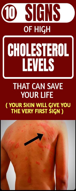 10 Symptoms Of High Cholesterol That You Shouldnt Ignore - wellness days