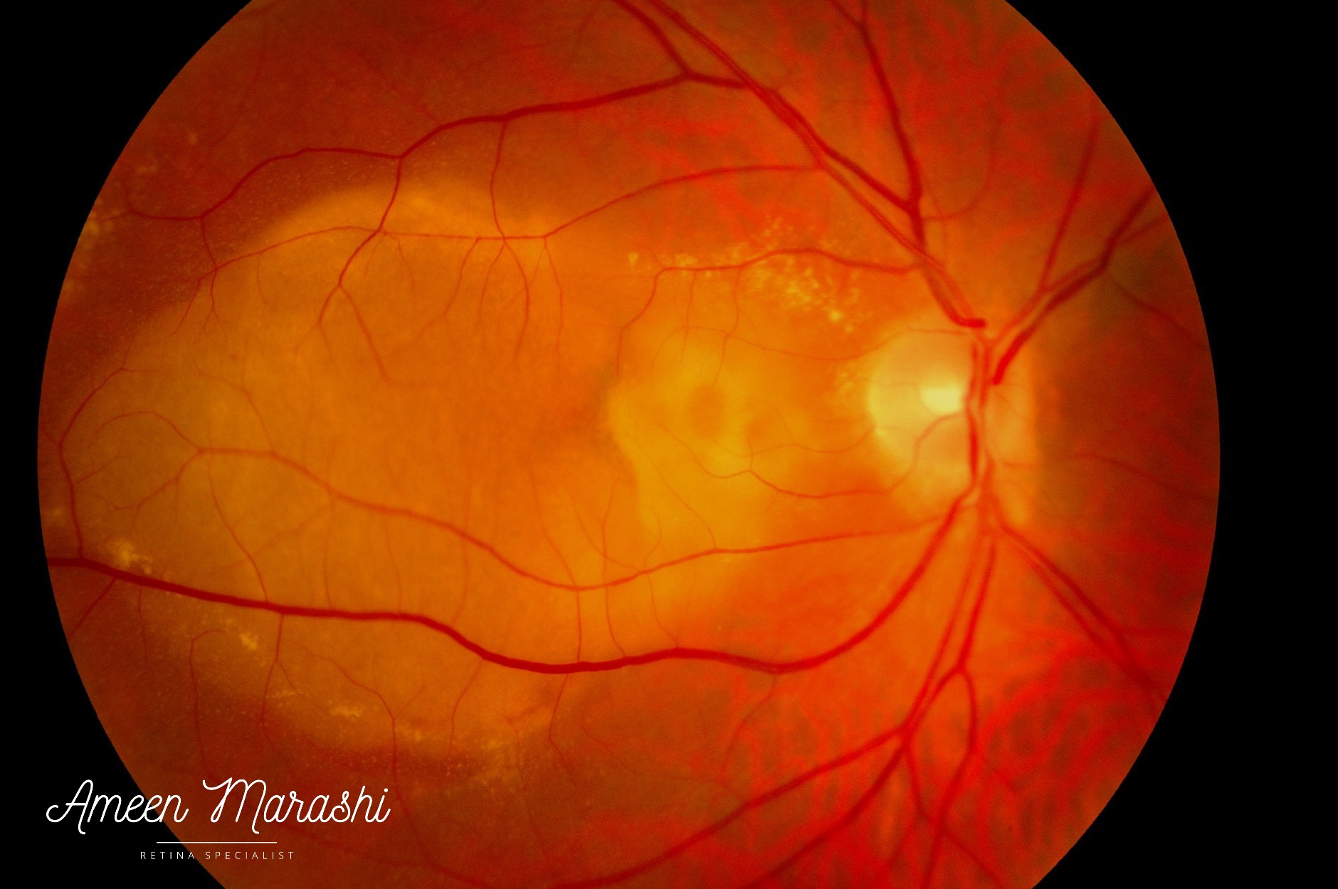 Approaching serous PED