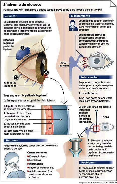 Ojo Seco Grave Y SjÖgren Recomendaciones Y Tratamiento Del Ojo Seco