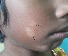Teledermatology for PG entrance: Hypopigmented patch on face- how to ...