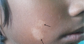 Teledermatology for PG entrance: Hypopigmented patch on face- how to ...