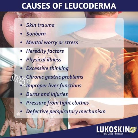 How Vitiligo Affects An Individual Life?: Symptoms and Causes of Leucoderma