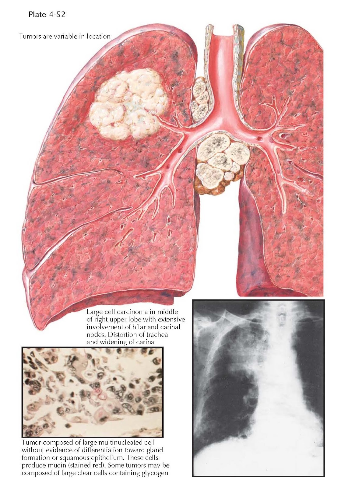 LARGE CELL CARCINOMAS OF THE LUNG - pediagenosis