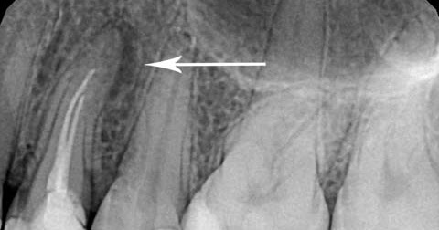 Igieneorale: Ascesso dentale : rimedi, sintomi e cause