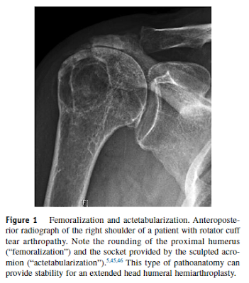 UW Shoulder and Elbow Academy: Cuff tear arthropathy - a safe and ...