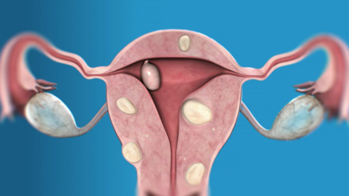 MIOMI NA MATERNICI OPASNA BOLEST-SAZNAJTE SVE O NJOJ I LIJEČITE JE OVAKO - Za Svakog Ponešto