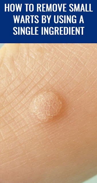 How to Remove Small Warts by Using a Single Ingredient - medicine ...