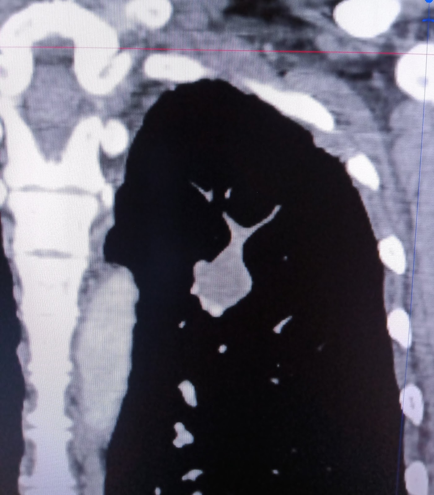 Segmental bronchial atresia-Case Report - Sumer's Radiology Blog