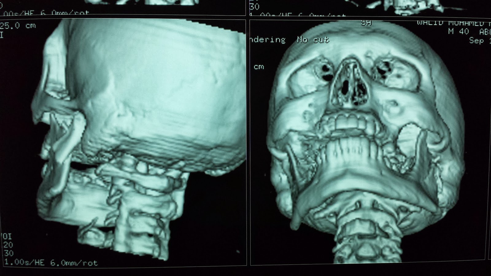 subcondylar fracture of the mandible CT scan