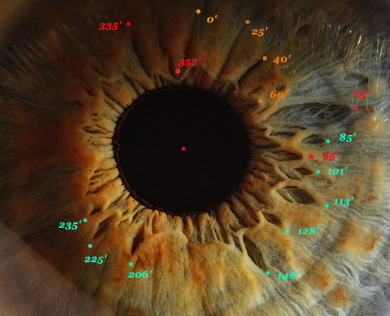 Modern & Multidimensional Iridology: Mixed/Biliary Iris Constitution ...