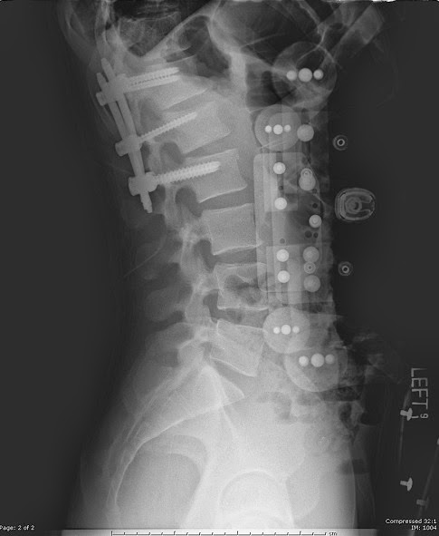 The BNA Neurosurgery Blog Spot: Minimally Invasive Spine Surgery ...