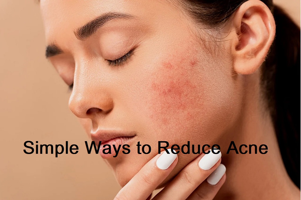 Simple Ways to Reduce Acne and Pimples - Blush Plush