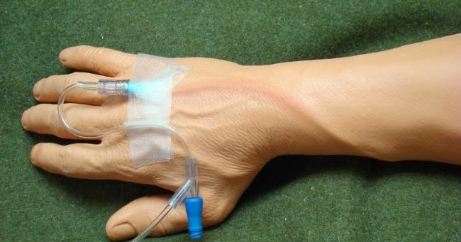 JAN interactive: Phlebitis in peripheral venous catheter sites