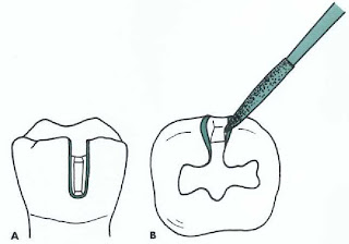 Restorasi Resin Komposit Kelas I | Dokter Gigi