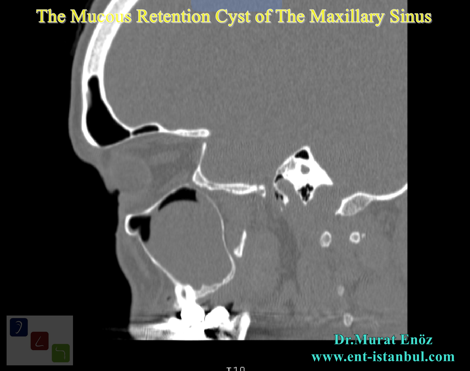 Health Zone Turkey: In Which Situations Is Paranasal Sinus Tomography ...