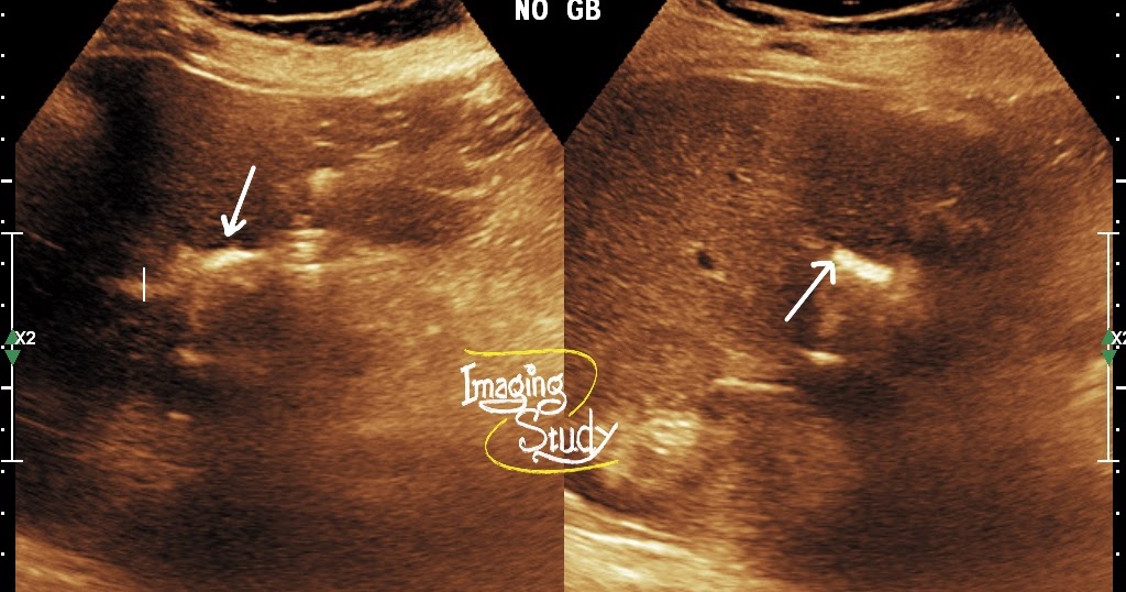 Imaging Study: Cholecystectomy Clips Ultrasound