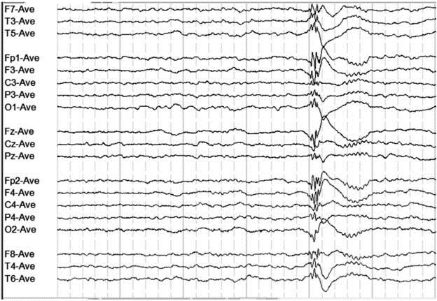 pediatric neurology: Epileptiform K-complexes and sleep spindles