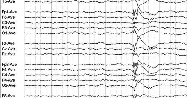 pediatric neurology: Epileptiform K-complexes and sleep spindles