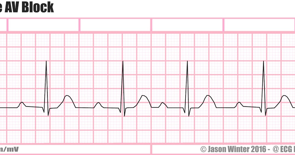 ECG Educator Blog : First Degree AV Bock ECG Educator Blog : First Degree AV Bock