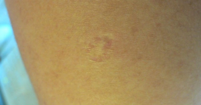 Do You Know the Truth Behind The Nickel-Sized Scar On The Upper Left ...