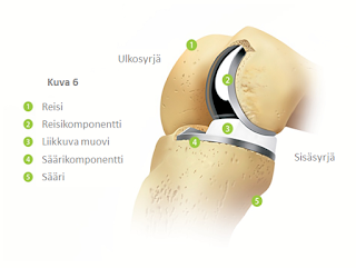 Sairaanhoitopalvelu-Leena: Kipu polven tekonivelleikkauksen jälkeen